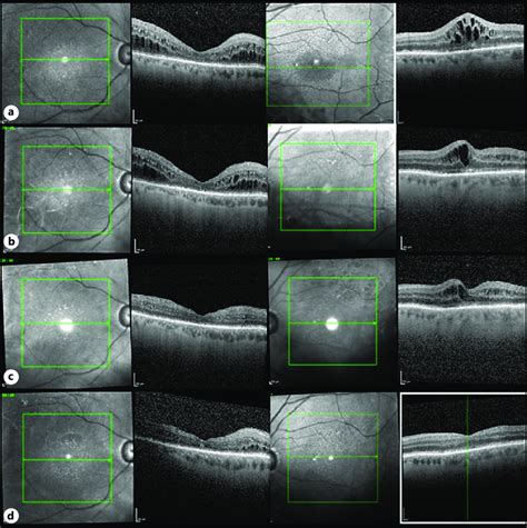 Optical Coherence Tomography Oct Scans Oct Scans Showing Bilateral