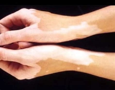 Doctor For Treatment Of Leukoderma At Delhi Ncr Noida And Patna Cancer Treatment Centre At