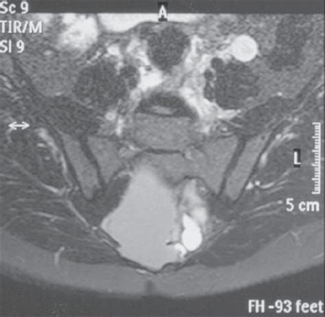 Magnetic Resonance Imaging Showing A Large Mass Lesion In Pre Sacral Download Scientific