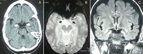 Non Contrast Ct Displaying Bilateral Symmetrical Hyperdensity Axial
