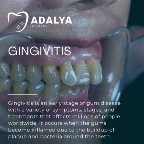 Gingivitis Symptoms Causes Treatment Adalya Dental Clinic