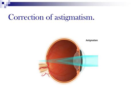 Ppt Latest Technological Wonder In Ophthalmology Lasik Laser