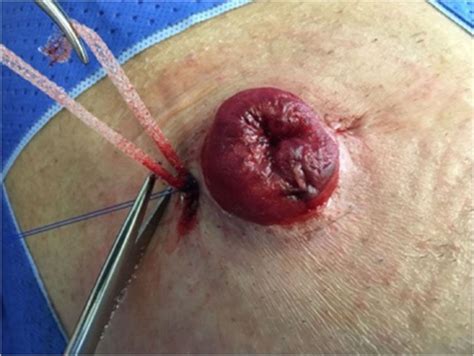 Local Treatment Of Colostomy Prolapse With The Mesh Strip Technique A