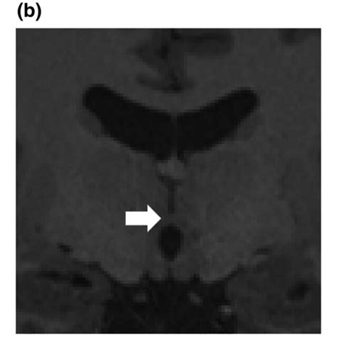 Identification Of Massa Intermedia Mi T1 Weighted Images Showing A