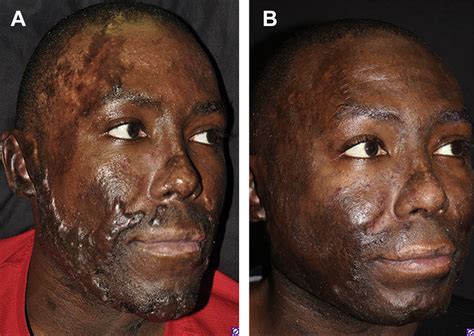Laser Modulation Of Hypertrophic Scars Clinics In Plastic Surgery