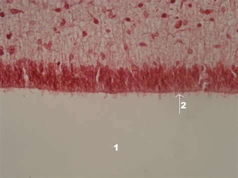 Plexus Choroideus Sflt Wikilectures