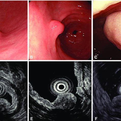 Gastric Inflammatory Fibroid Polyp A C Endoscopic Images Showing A Download Scientific
