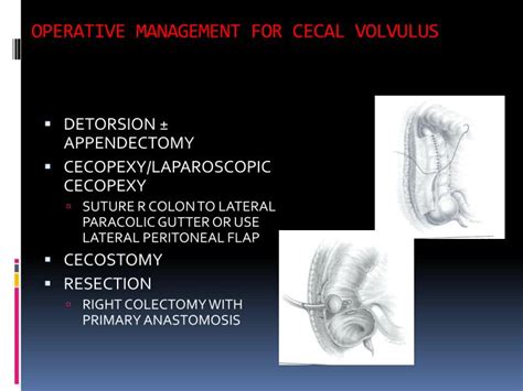 Ppt Volvulus Powerpoint Presentation Id 3343529