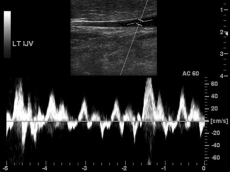 Ue Venous Dvt Unit 2 Flashcards Quizlet