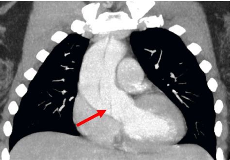 The Challenge Of Cesarean Section At The Time Of Aortic Dissection