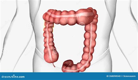 Chronic Idiopathic Constipation Is A Gastrointestinal Condition Characterized By Long Term