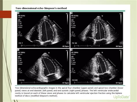 Lv Systolic Function Pptx