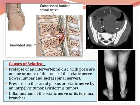 08anatomy Of The Sciatic Nerve And It Formation Ppt