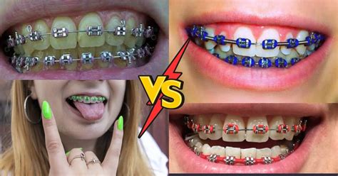Lavender Braces The Trendy Way To Add Style To Your Smile
