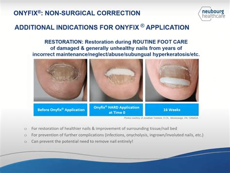 Onyfix Ingrown Toenail Treatment Podiatrist Foot Doctor Hallandale