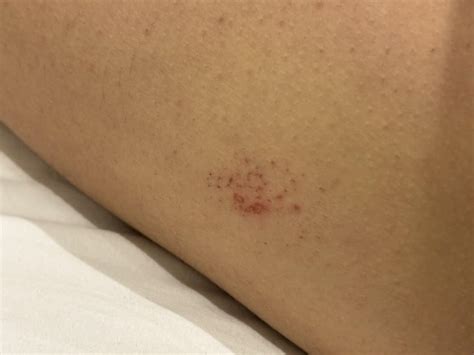 Inner Thigh Rash Itches What Is It R Dermatologyquestions