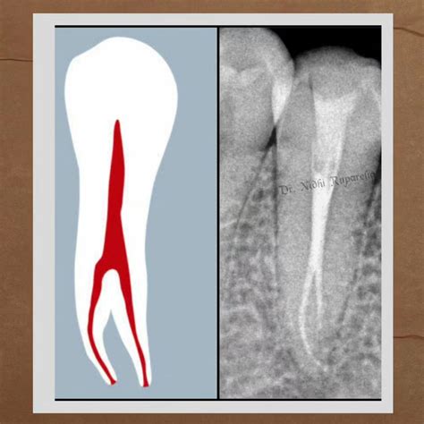 Easy Premolar Vertucci Type V At First Glance Apical Bifurcation