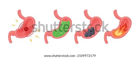 47 Imágenes De Pirosis Imágenes Fotos Y Vectores De Stock Shutterstock