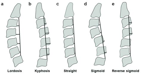 Schematic Of The Sagittal Alignment Of The Cervical Spine On Lateral Download Scientific
