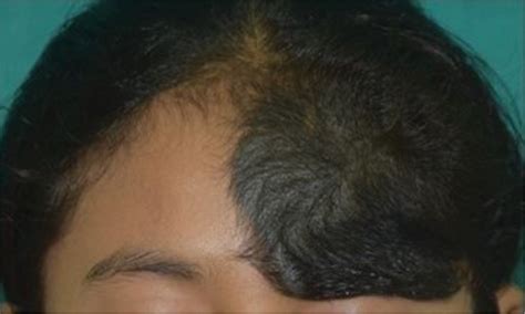 Segmental Hairy Nevus Cosmoderma