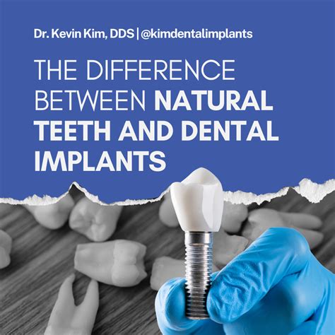 The Difference Between Natural Teeth And Dental Implants Dr Kevin