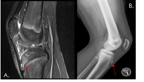 Tibial Tuberosity