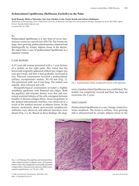 Pdf Pedunculated Lipofibroma Hoffmann Zurhelle On The Palm