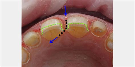 Predictable Ceramic Veneer Margins Eliminate Unsupported Enamel With