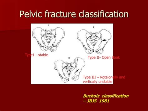 Pelvis Acetabulum Anatomy Imaging Classification Pptx