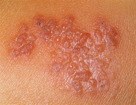 Itchy Blister Rash Pictures Causes And Treatment