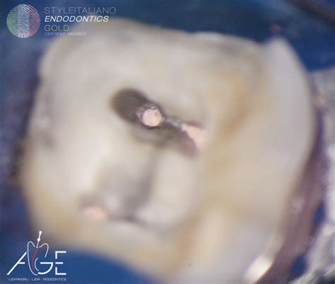 Root Canal Retreatment Of A Lr6 Using Mg3 File System From Perfect A