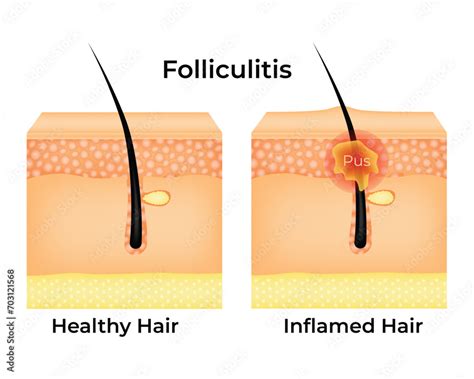 Folliculitis Science Design Vector Illustration Diagram Stock Vector