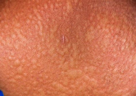 The Dangers Of Untreated Cold Urticaria Complete Guide • Dumblittleman