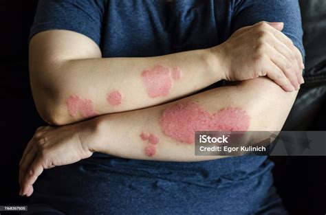 Penyakit Kulit Dermatologis Psoriasis Eksim Dermatitis Alergi Lesi Kulit Pada Siku Foto Stok