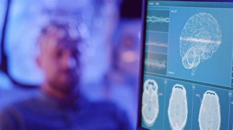 Psychogenic Nonepileptic Seizures Exploring Unmet Needs Nyu Langone