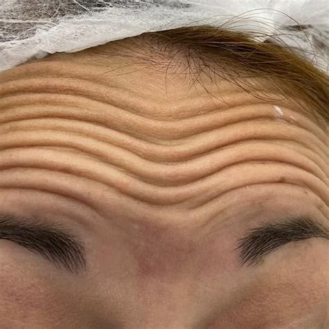 Expression Lines Treatment Clinica Joia