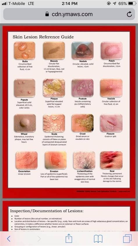 Skin Lesions Types With Chart Pictures Causes Treatment 56 Off