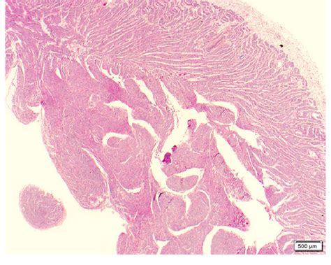 Histopathologic Section From The Rv Wall Showing Coarse And Fine