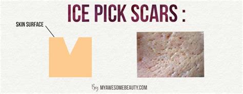 How To Get Rid Of Acne Scars Fast The 20 Best Treatments And Tips