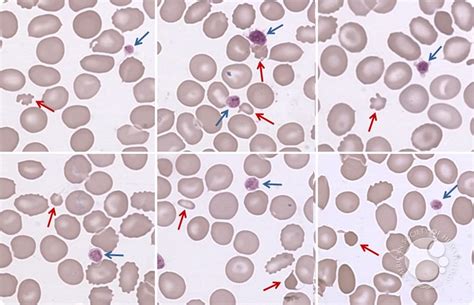 Platelets Under Microscope Red Blood Cells And Platelet In Blood Smear
