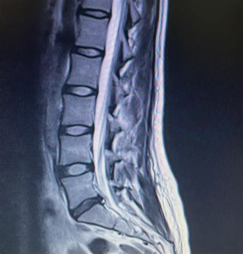 Herniated Disk Rsciatica