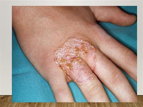 Ringworm Ringworm Is A Common Fungal Infection Also Known As Tinea Pptx