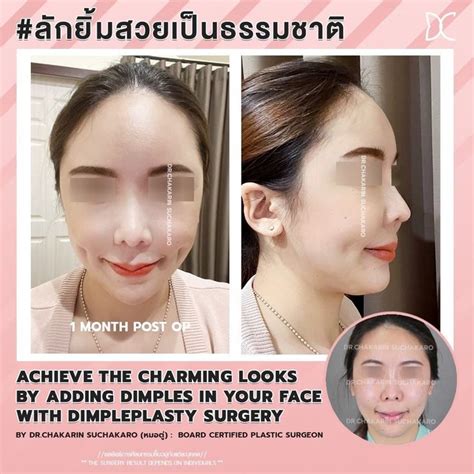 Want To Look More Charming With A Dimple When You Smilewhy Not