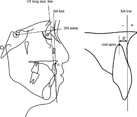 Lateral Cephalometric Analysis A U1 Sn Angle 8 B U1na Angle 8