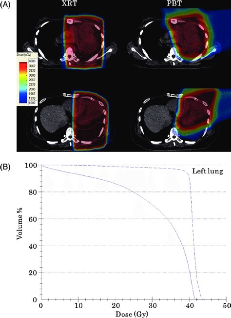 A Colorwash Isodose Distribution For Photon Radiation Therapy And