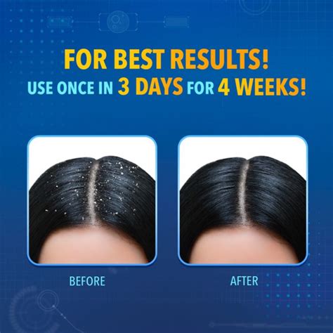 Buy Scalpe Plus Shampoo Ml In Wholesale Price Online B B Retailershakti