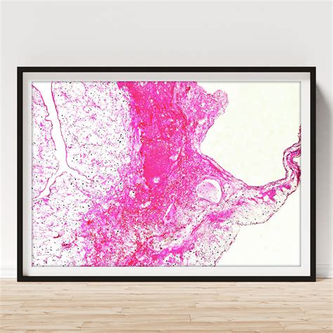 Cardiac Sarcoma 1 Poster By Science Photo Library Science Photo Gallery