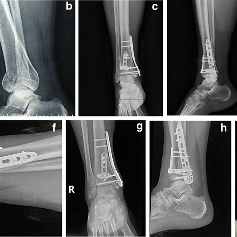 The Anteroposterior And Lateral X Rays Of A Pilon Fractures A And