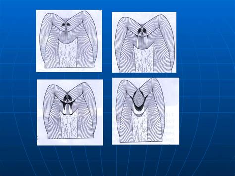 Classification Of Dental Caries Ppt