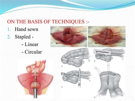 Bowel Resection And Anastomosis Pptx